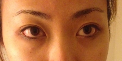 Revision Incision Parallel Crease, 8mm, Medial Epicanthoplasty - Los Angeles, CA - Asian Eyelid ...