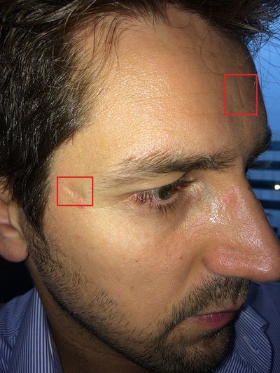 Depressedindented Scars On The Forehead Any Suggestions Photos Doctor Answers Tips