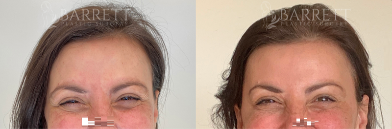 Barrett plastic surgery store