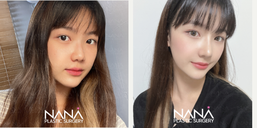 Nana Plastic Surgery Hospital Dermatology Seoul Seoul Realself