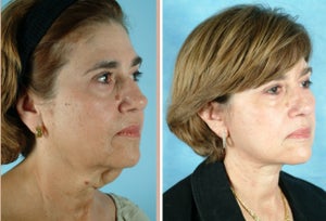 Facelift Naples
