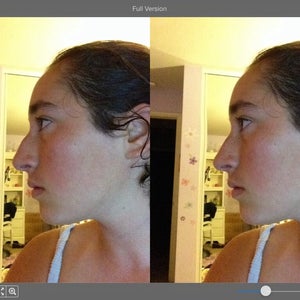 Is it possible to shave the hump in my nose without an Osteotomy photo