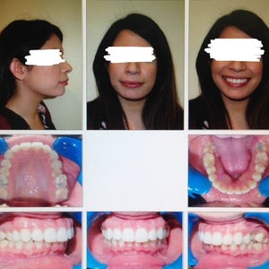 overjet correction with extraction