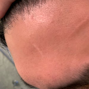 hypopigmentation scars