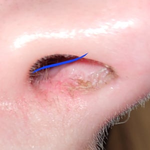 nose inside wound