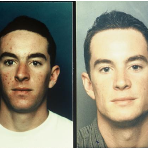 gonial angle implants