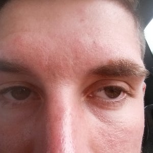birthmark on forehead between eyebrows