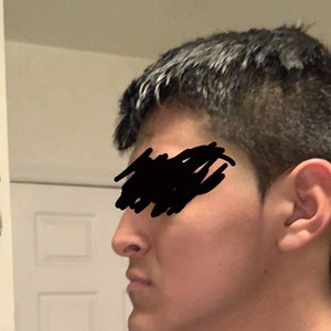 mandibular prognathism