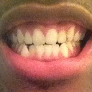 veneers overcrowded teeth