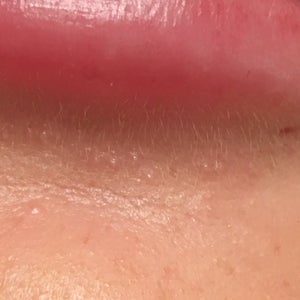 What Are The Little Bumps Under My Lip