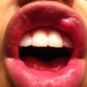 bump on upper lip inside