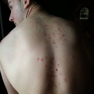 back acne really bad