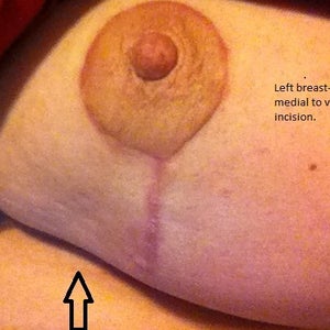 breast surgery problems
