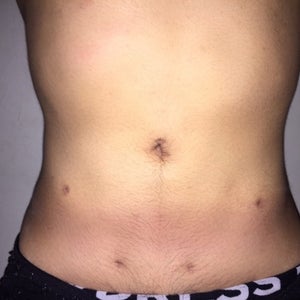 liposuction scars belly