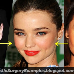 Miranda Kerr Before And After Plastic Surgery