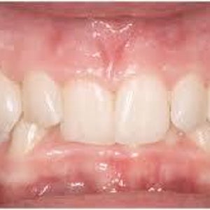 deep bite after invisalign