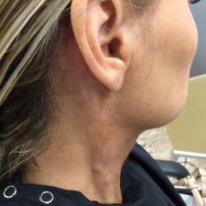 lymph node removal face