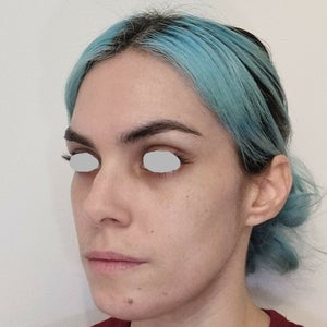 forehead bone shaving