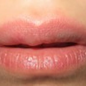 bump on upper lip