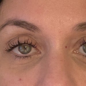 lower bleph gone wrong