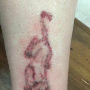 bleeding tattoo removal