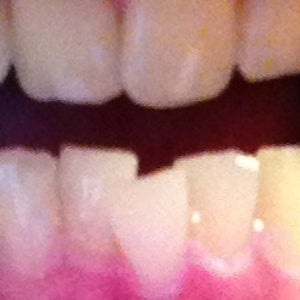 crowded teeth veneers