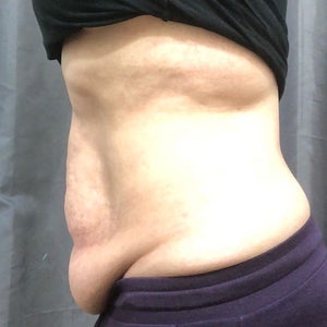Botched Tummy Tuck Desiree