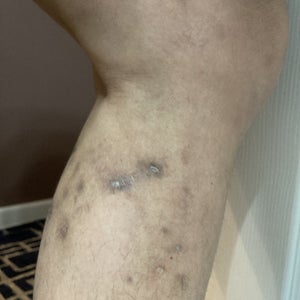 bad circumcision scars