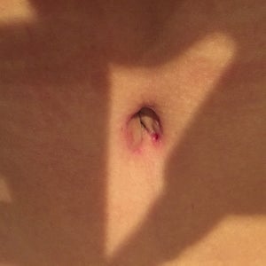 belly button healed