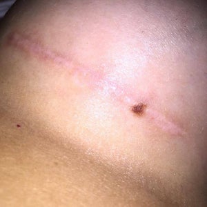 why do scars leave dark marks