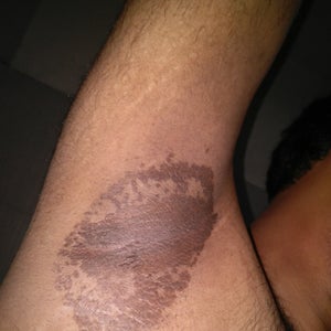 dark marks underarms