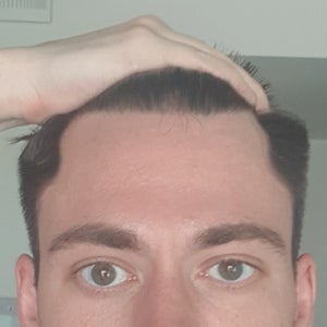 Normal Hairline Corners