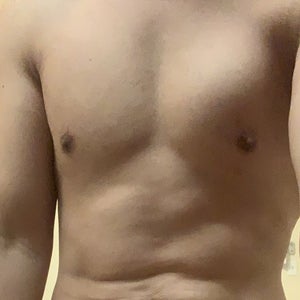 vaser lipo gone wrong