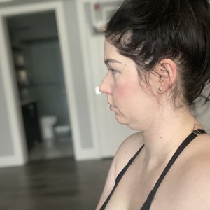 overbite side profile