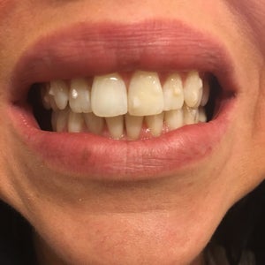 overjet teeth invisalign