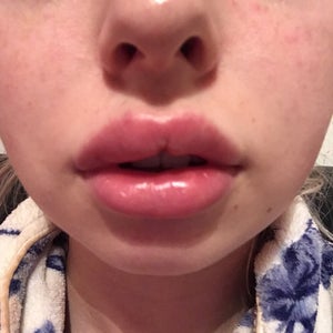 Redness And Swelling Lips After Filler | Lipstutorial.org