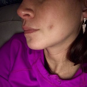 dimpleplasty gone wrong