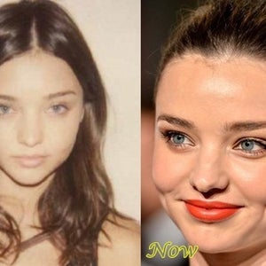 Miranda Kerr Before And After Plastic Surgery