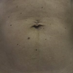 What can be done for my saggy belly button Photos