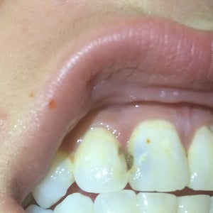 tiny holes on upper lip
