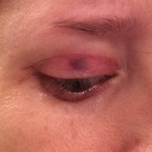Small hematoma in upper eyelid 3 weeks after upper and lower blepharoplasy. Will this go away on its own Photo