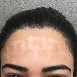 hypopigmentation over eyebrows