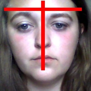 uneven eyebrows surgery