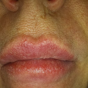 What Does An Allergic Reaction On Lips Look Like | Lipstutorial.org