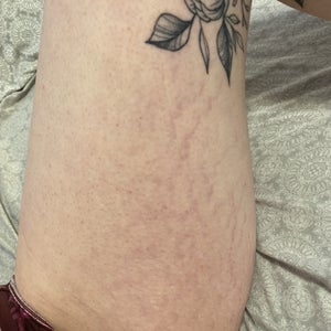 thigh stretch marks