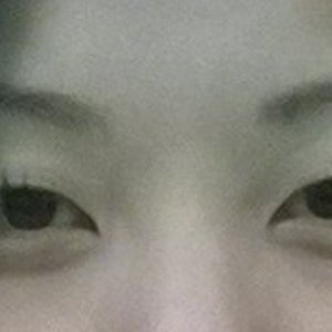 double eyelid surgery gone wrong