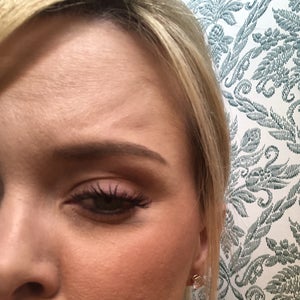 indent in head after hitting it