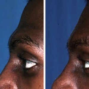 Prominent Brow Ridge Reduction