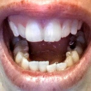 crowded teeth veneers