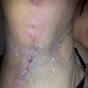 forearm surgery stitches